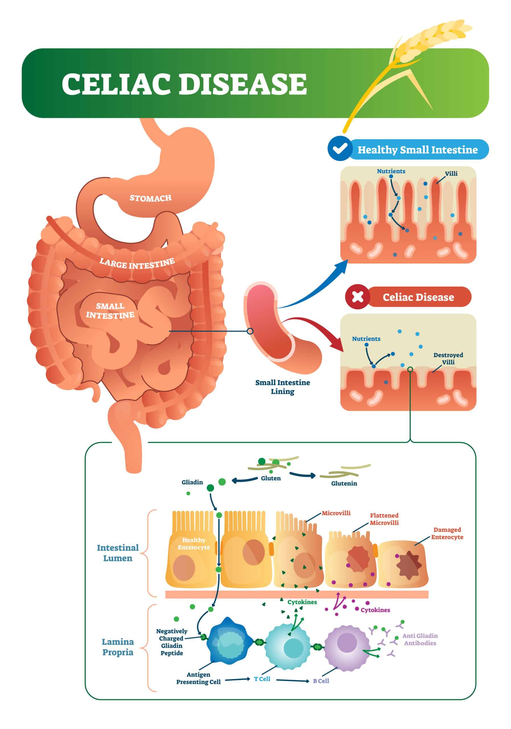 What Causes Celiac Disease | Pompa Program Masterclass