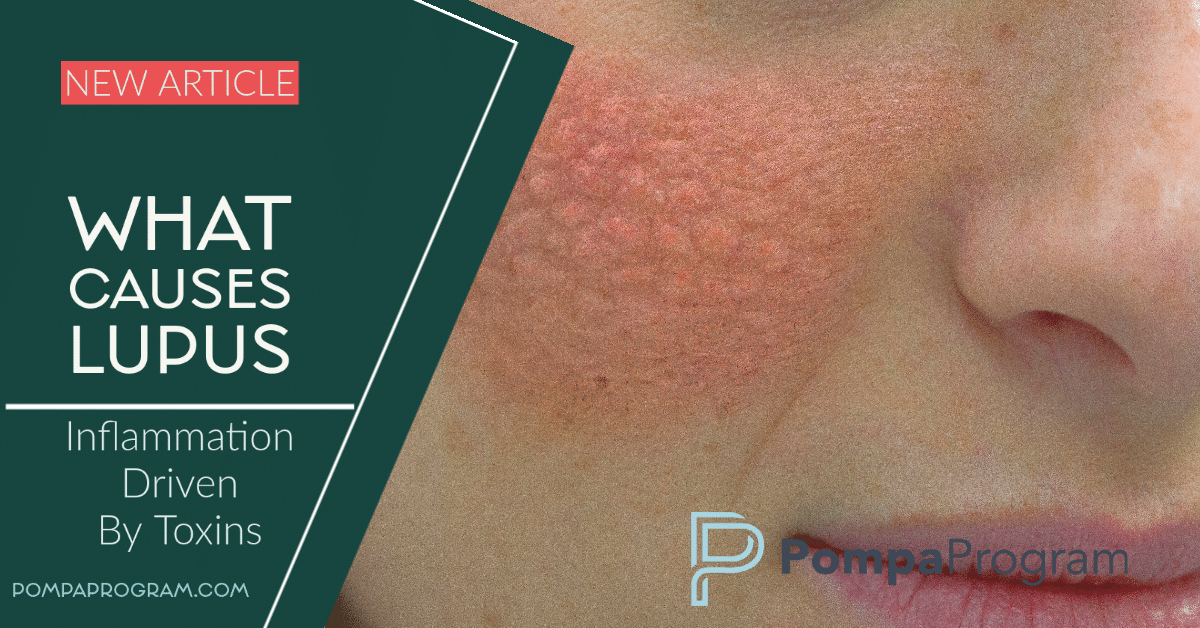 What Causes Lupus | Pompa Program